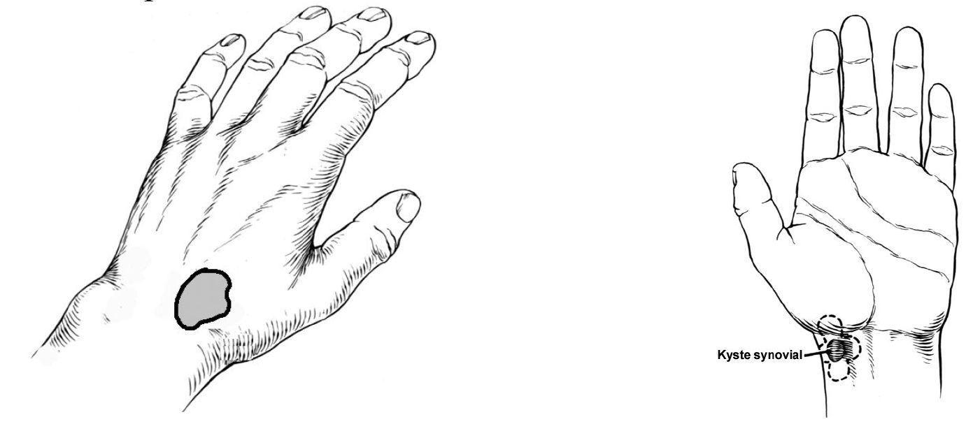 Kyste Synovial - CENTRE de la MAIN Bretagne